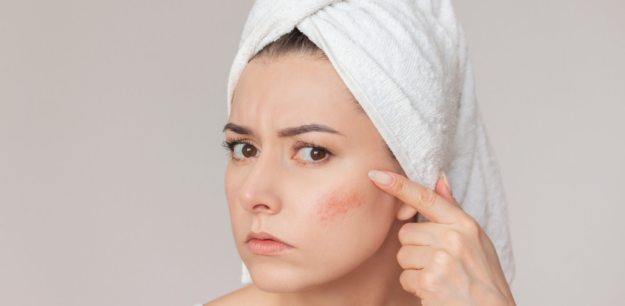 Acné rosacée, que faire contre ? - Feelgoods Pharmacies